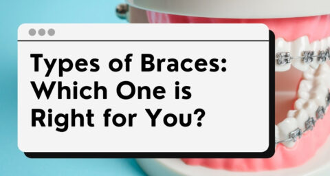 Types of Braces: Which One is Right for You? - The Singaporean